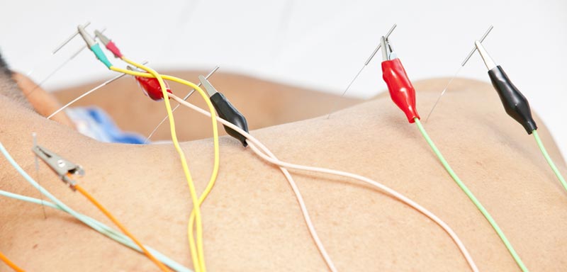 Expectancy in Real and Sham Electroacupuncture