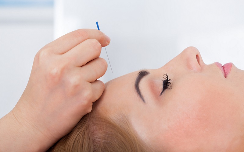 8 More Reasons To Try Acupuncture
